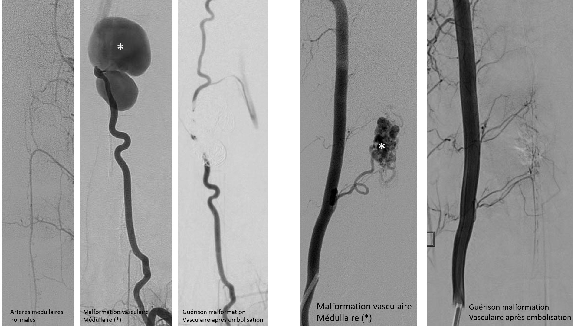 Neuro MAV France | LES MALFORMATIONS ARTERIOVEINEUSES MÉDULLAIRES